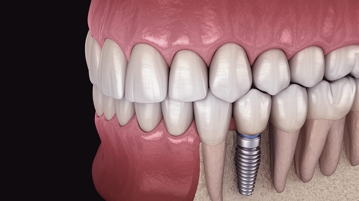 The Best Treatments for Replacing Missing Teeth - Mesa Street Dental